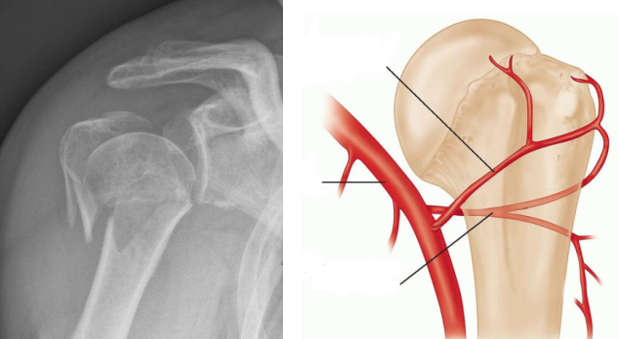 Fracture de l'extrémité supérieure de l'humérus | Hôpital DCSS