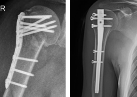 Fracture de l'extrémité supérieure de l'humérus | Hôpital DCSS