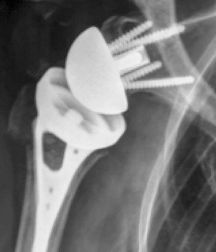 Fracture de l'extrémité supérieure de l'humérus | Hôpital DCSS