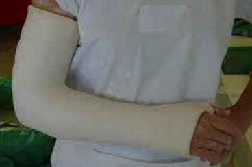 Fracture de l'olécrane | Hôpital DCSS